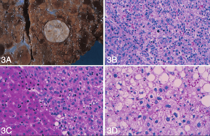 Tirosinemia – Hepcentro