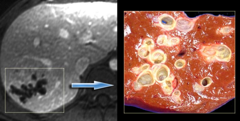 Doença e Síndrome de Caroli – Hepcentro