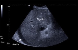 Ascite – Hepcentro