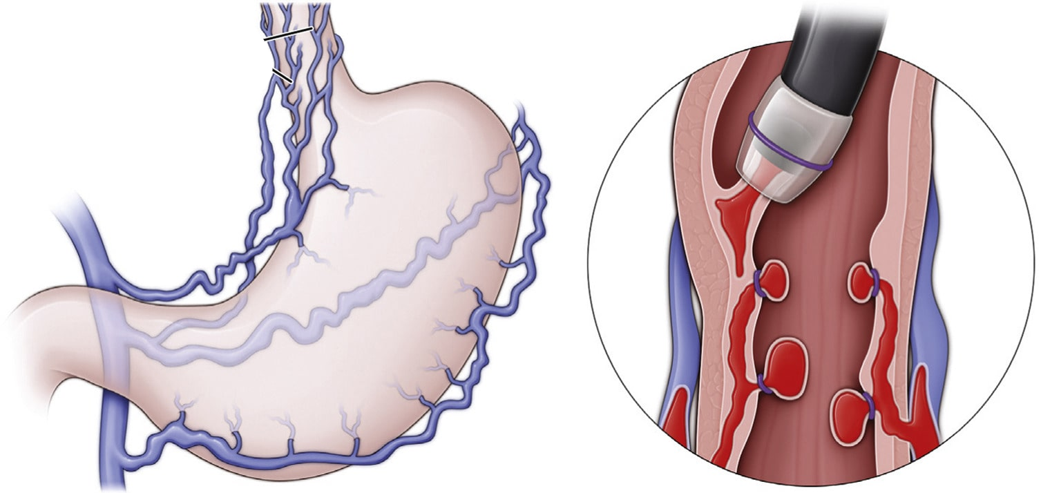 Ligadura Elástica de Varizes Esofágicas – Hepcentro