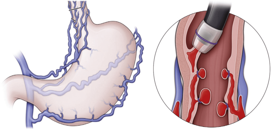 Ligadura Elástica de Varizes Esofágicas – Hepcentro