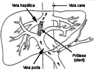 Varizes Gastroesofágicas – Hepcentro